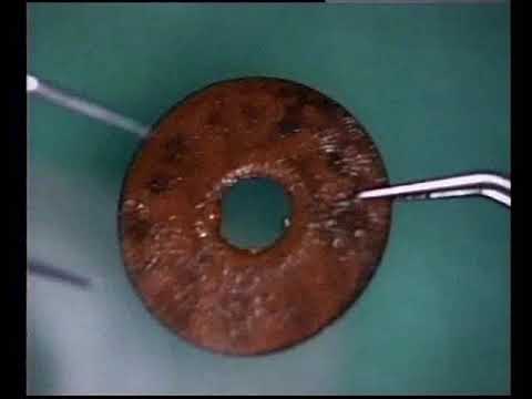 Implantación de un Iris artificial de Humanoptics en Iris defectuoso ...