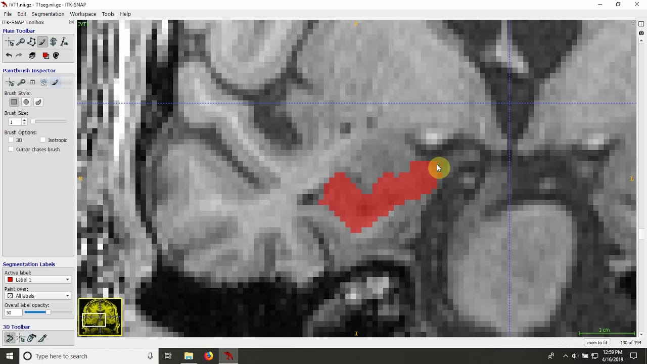 Demonstration of whole hippocampus segmentation on T1-weighted MRI - YouTube