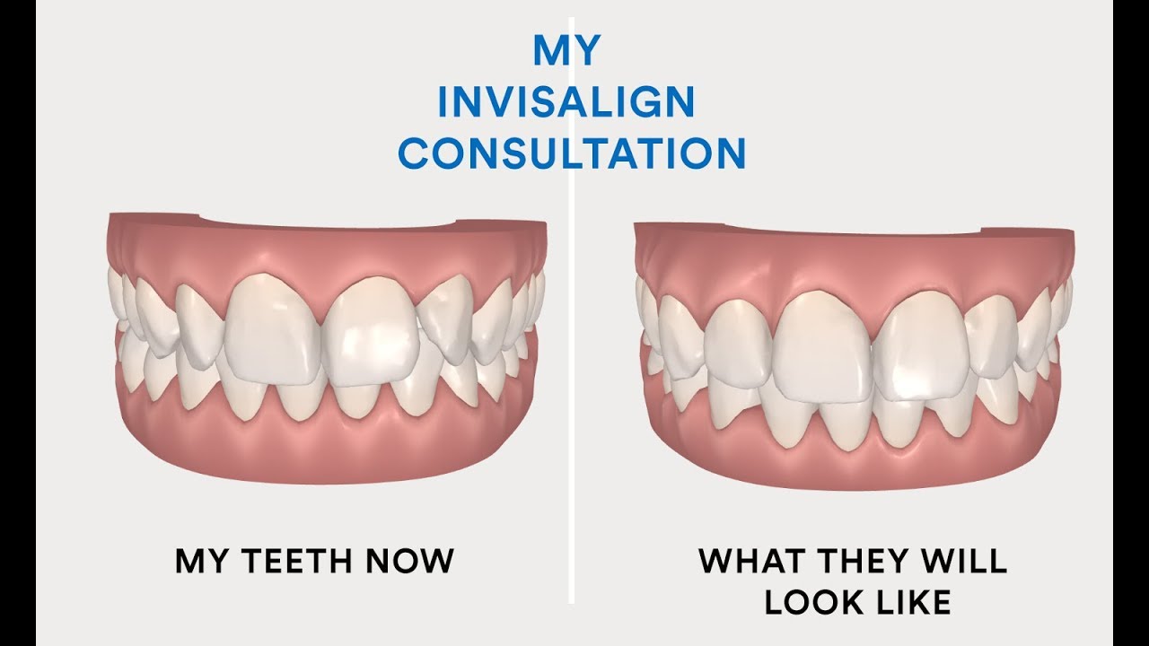 MY INVISALIGN JOURNEY #1 Consultation - YouTube