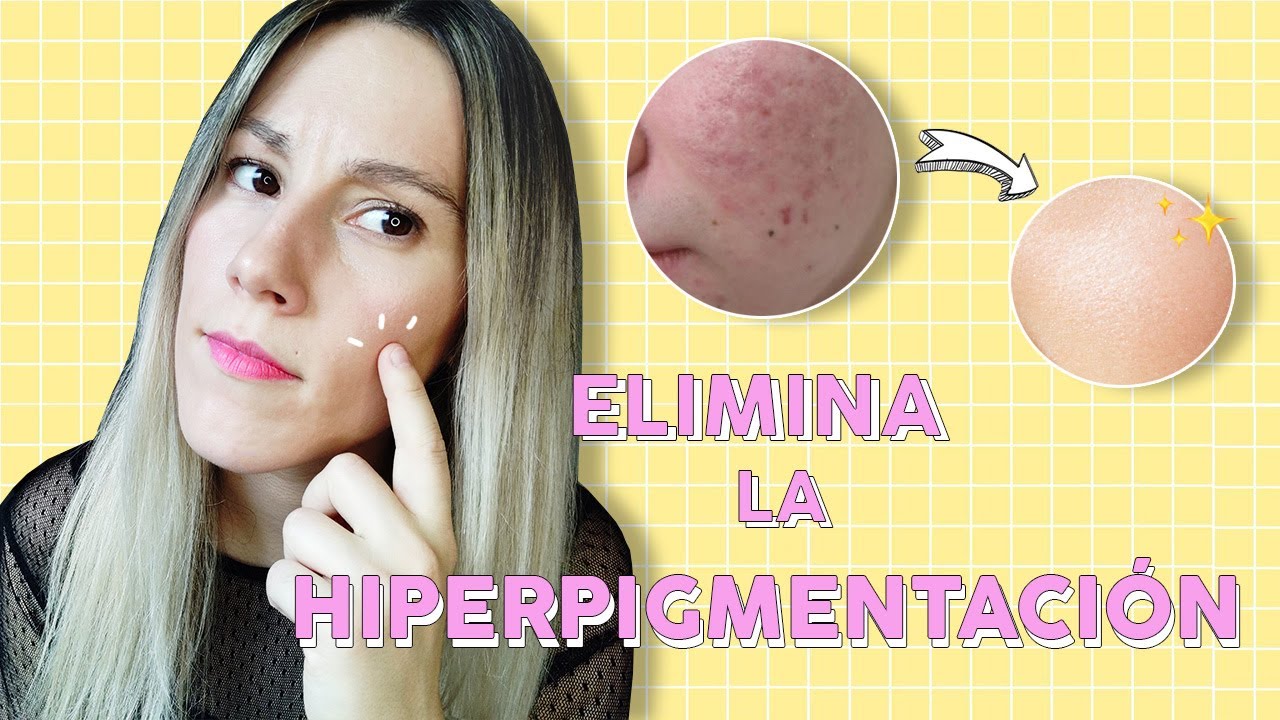 COMO ELIMINAR MARCAS DE ACNÉ ACLARA* Tu Piel Con Estos Ingredientes ...