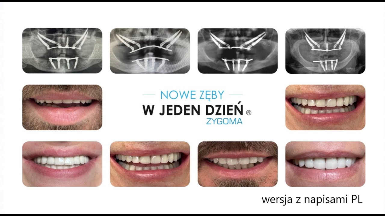 🦷💎⭐️ NOWE ZĘBY W JEDEN DZIEŃ ZYGOMA® IMPLANTY ZYGOMATYCZNE - JARZMOWE ...
