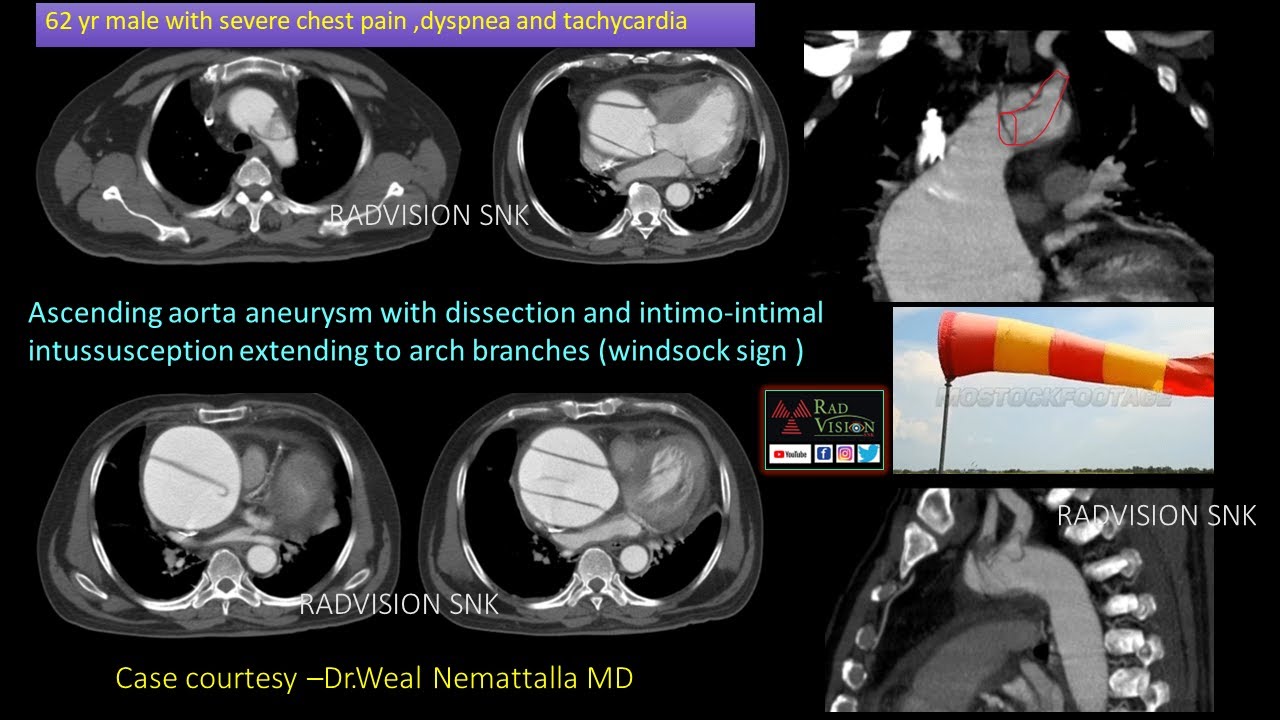 Windsock sign -intimo-intimal aortic intussusception -classic cases -7 ...