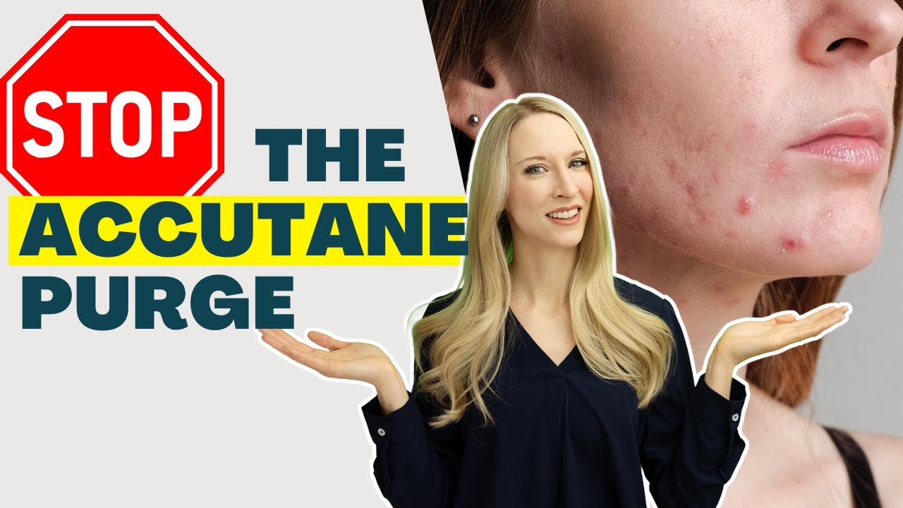 Accutane Acne Purge? Do THIS - YouTube