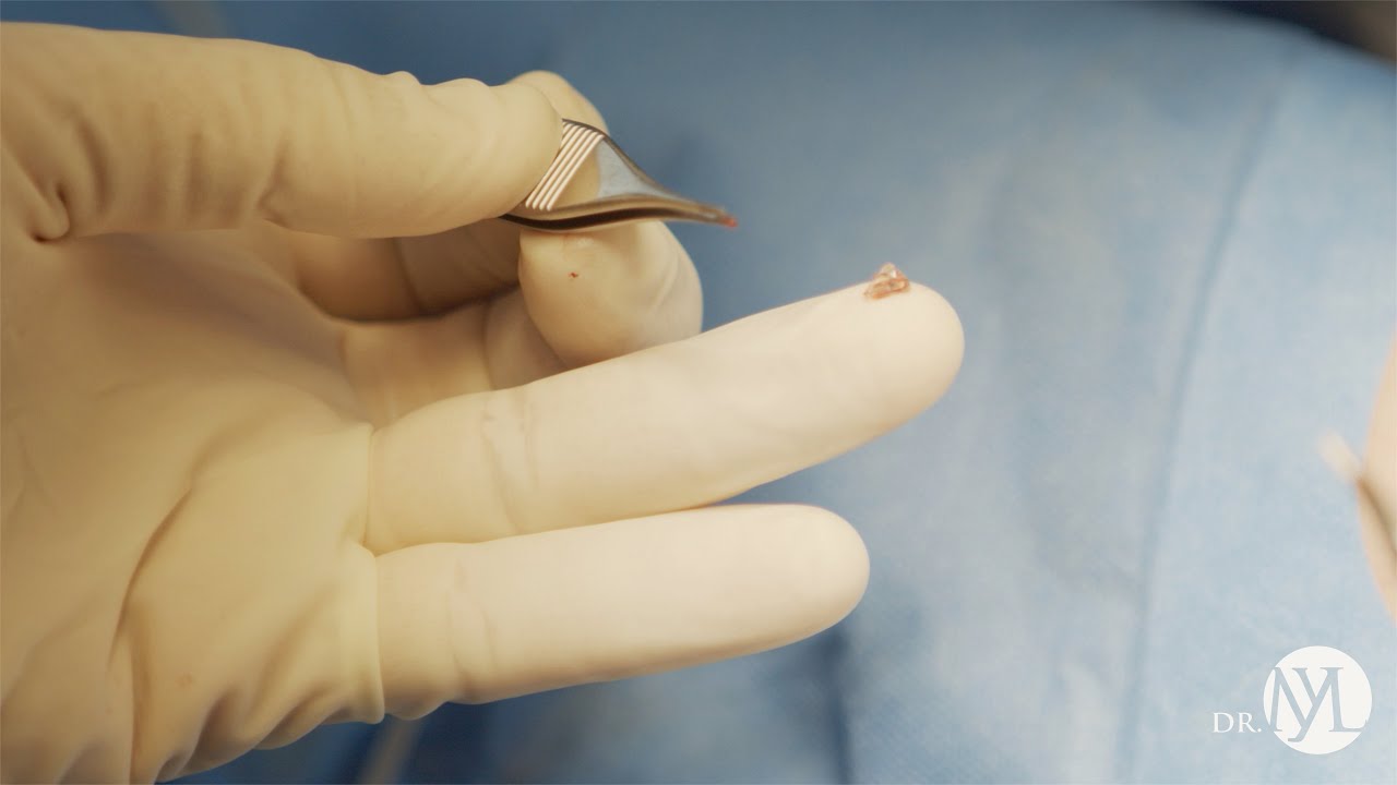 Excizie corp strain (chirurgie plastica & estetica) - Dr.Levy Medical ...