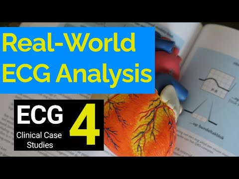 Real-World ECG Analysis (4): Clinical Case Studies in ...