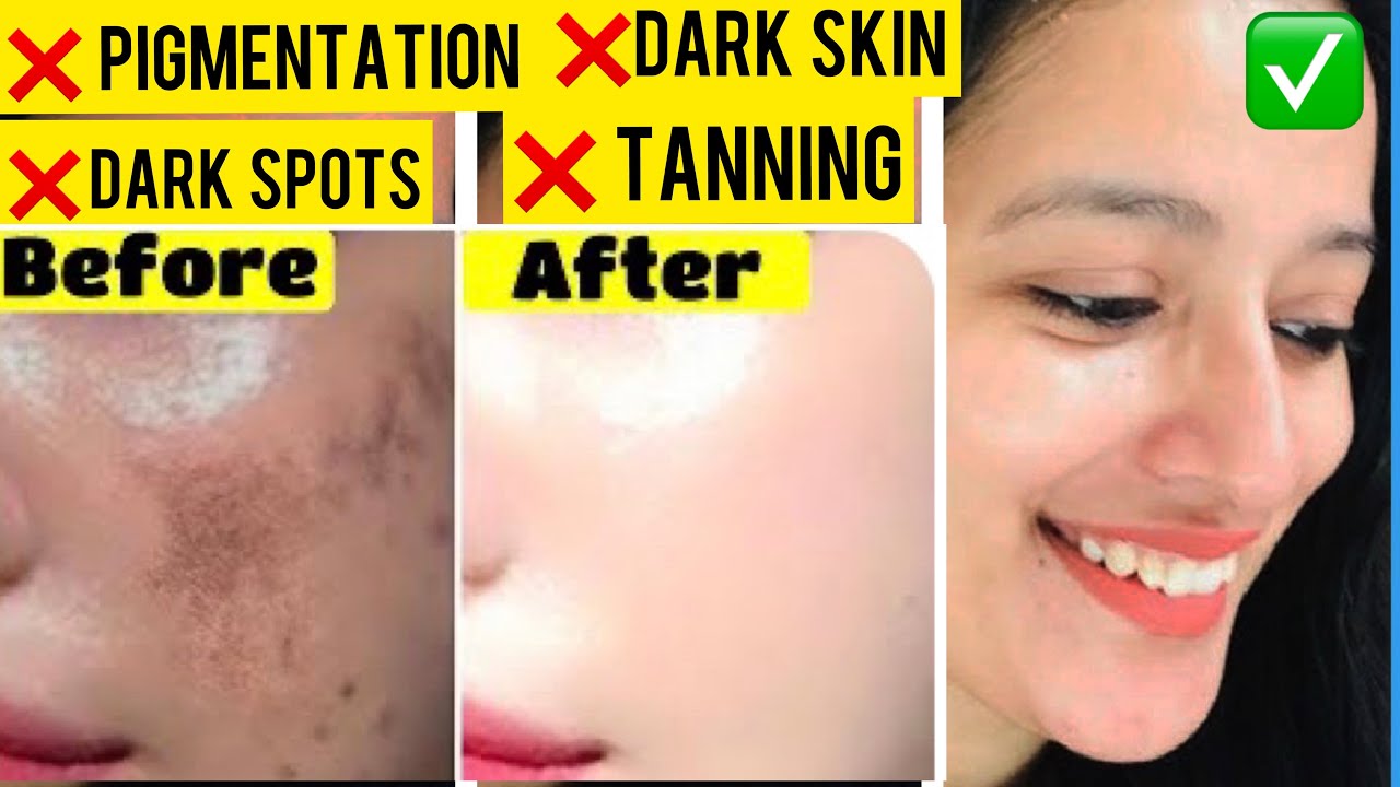 DIY Face Wash Every Girl / Women Should Know for Pigmentation , Acne , Pimple , Dark patches- 😱 ...