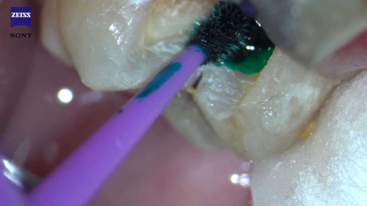 caries profunda - YouTube