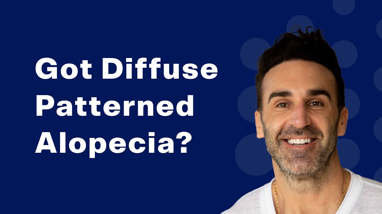 Diffuse Patterned Alopecia (DPA)? Try This... - YouTube