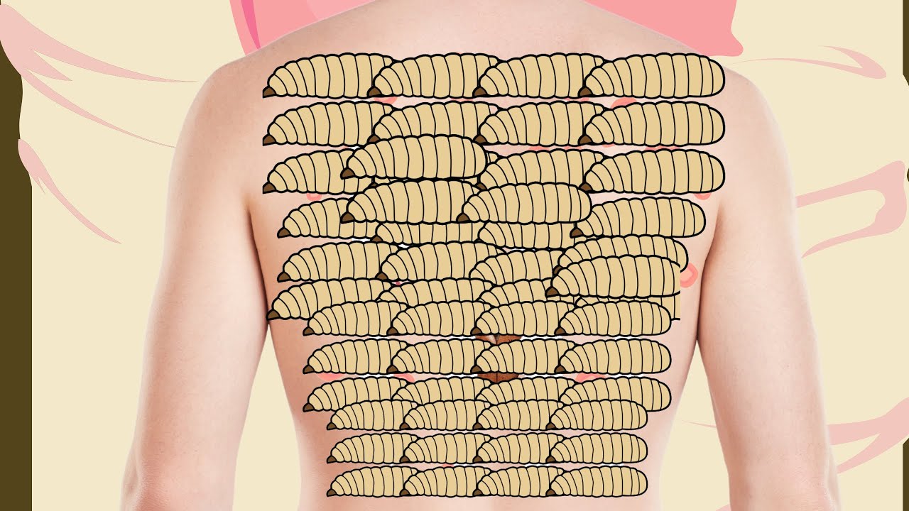 ASMR How to removal dog tick infested man back injured - YouTube