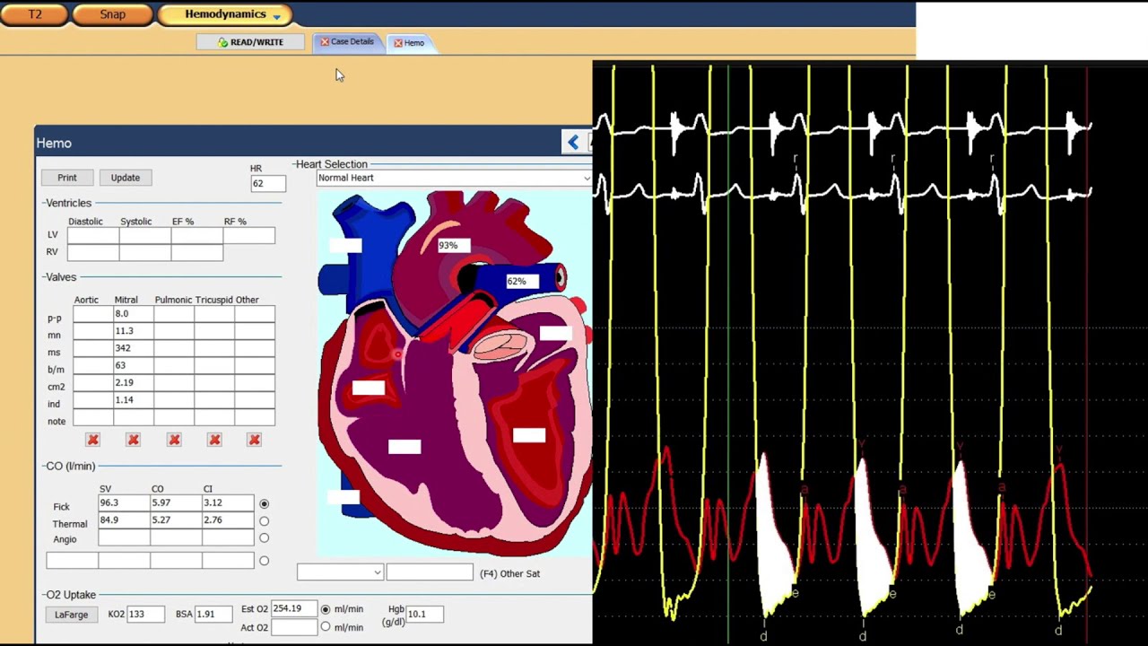 Assessing Mitral Stenosis in the Cath Lab - Hemodynamic Workstation ...