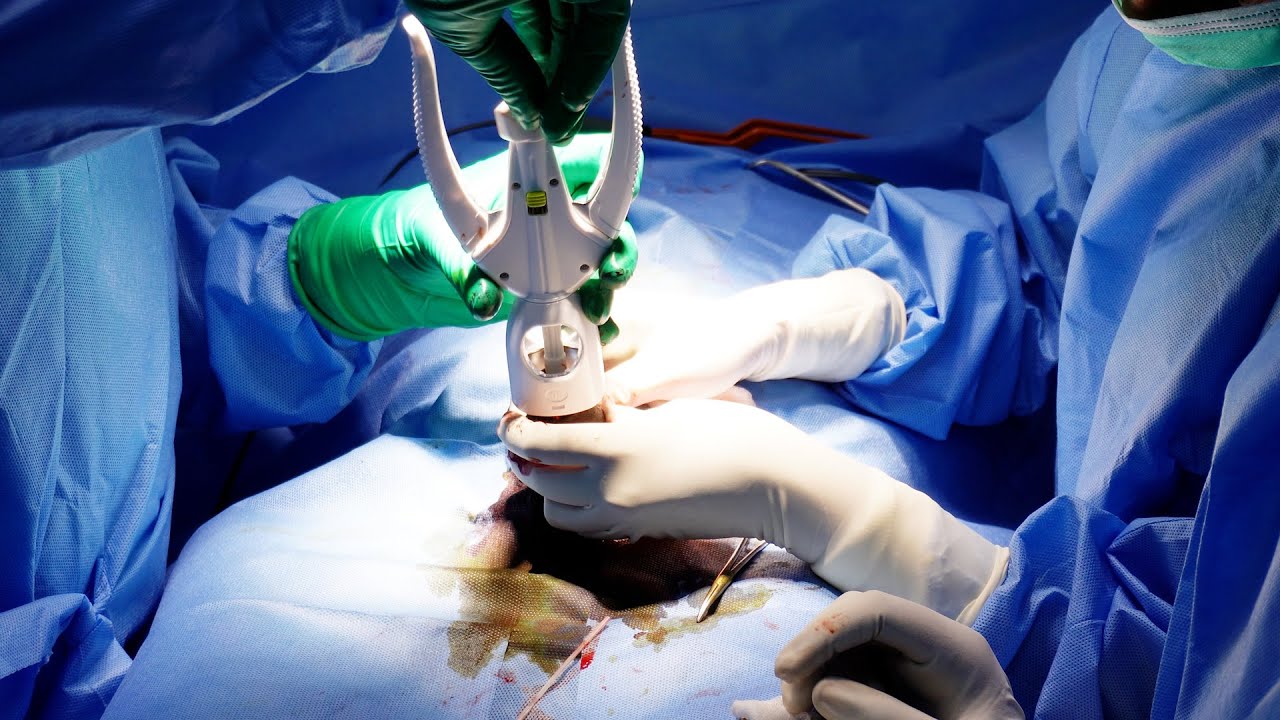 ZSR Circumcision | The Game-Changer in Men's Surgery - YouTube