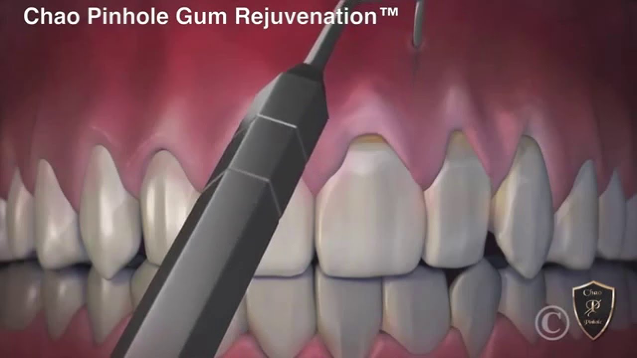 Chao Pinhole Surgical Technique Dr. Noroozi IMPrESS Perio Vancouver ...