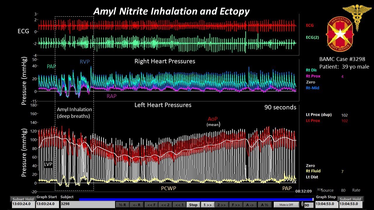 BAMC 3298 Part 1: Amyl Nitrite Inhalation and Ectopy (Right and Left ...