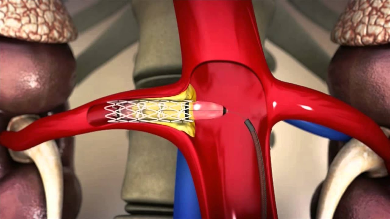 FLASH Ostial System - Animation - YouTube