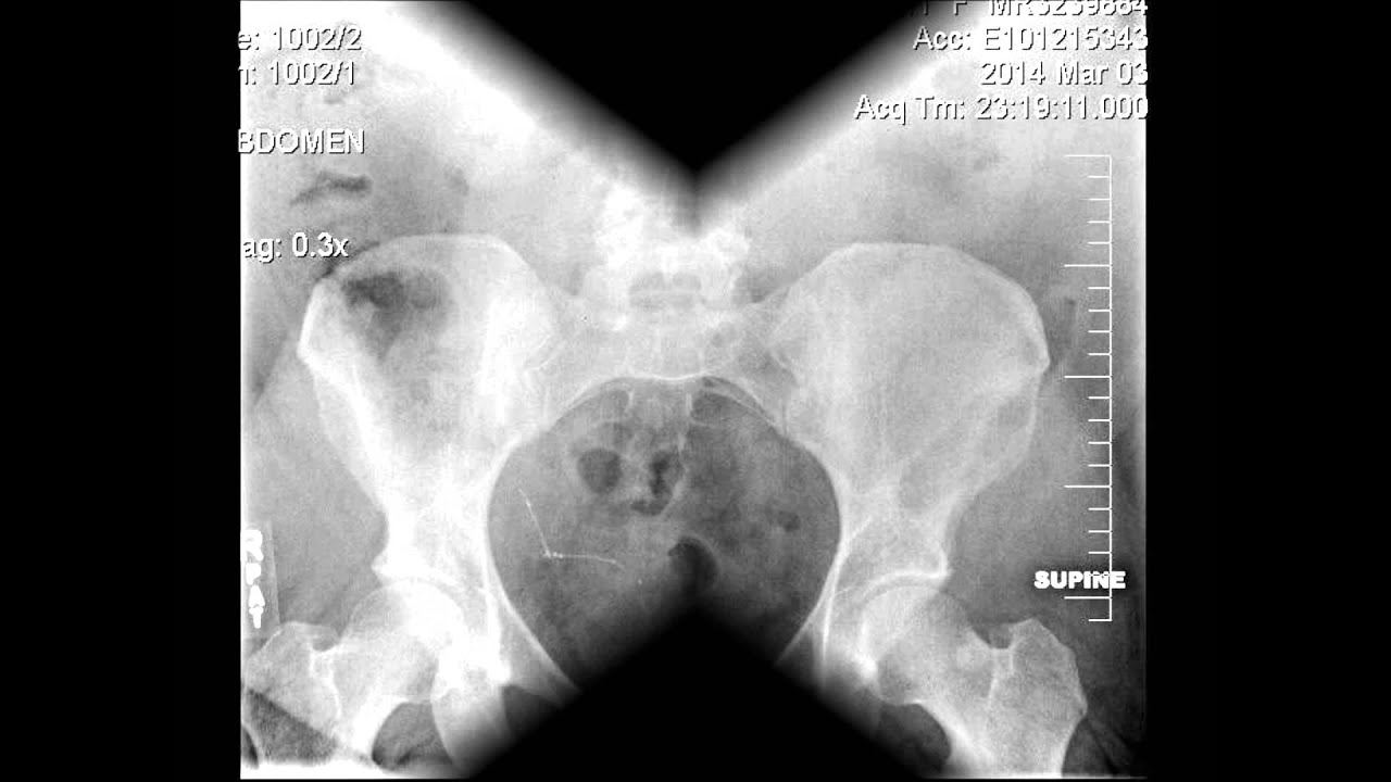 Essure Placement Rate Failure - YouTube