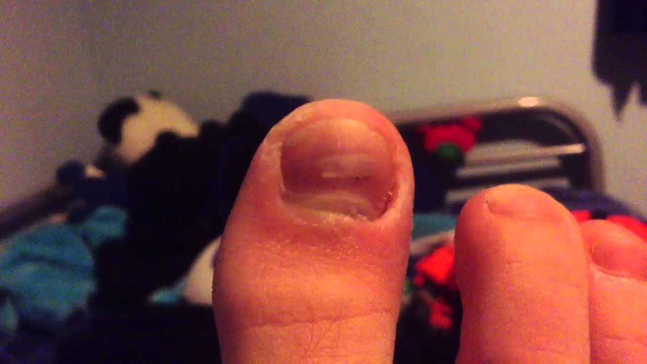 Sore toe - YouTube