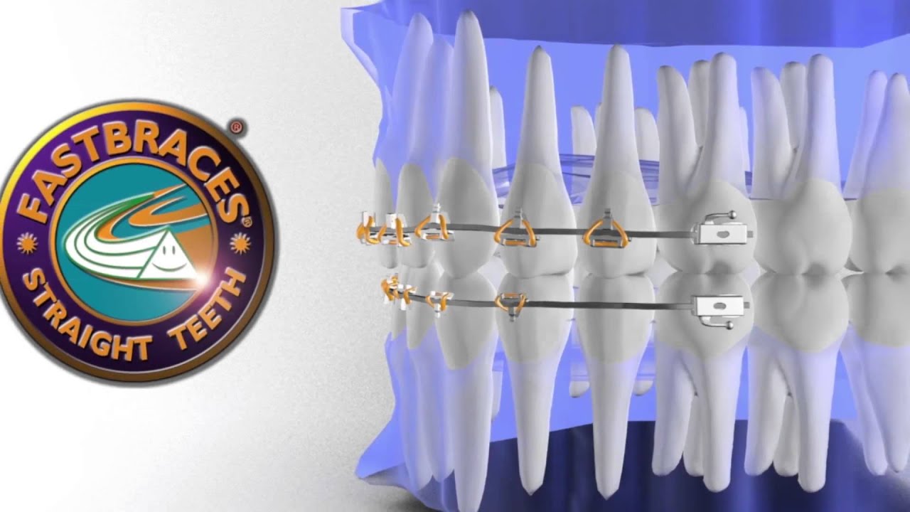 Fastbraces® are Easy from Dr Terry Hopper DMD - YouTube