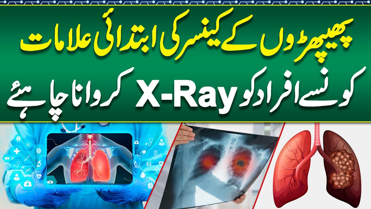 Lung Cancer Ka ilaj - Lung Cancer Symptoms, Causes and Treatment - Stages of Lung Cancer - YouTube