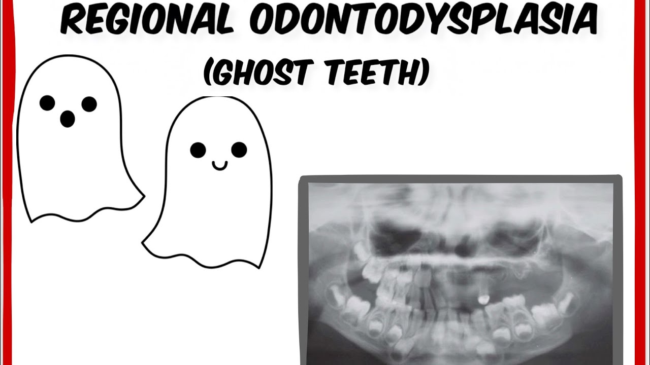 Regional Odontodysplasia (Ghost Teeth) - YouTube