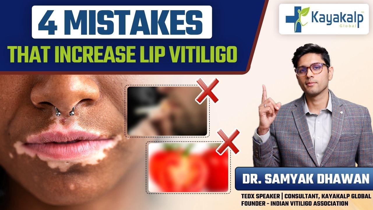 होठों पर सफ़ेद दाग (Lip Vitiligo) बढ़ाने वाली 4 गलतियां मत करना ...