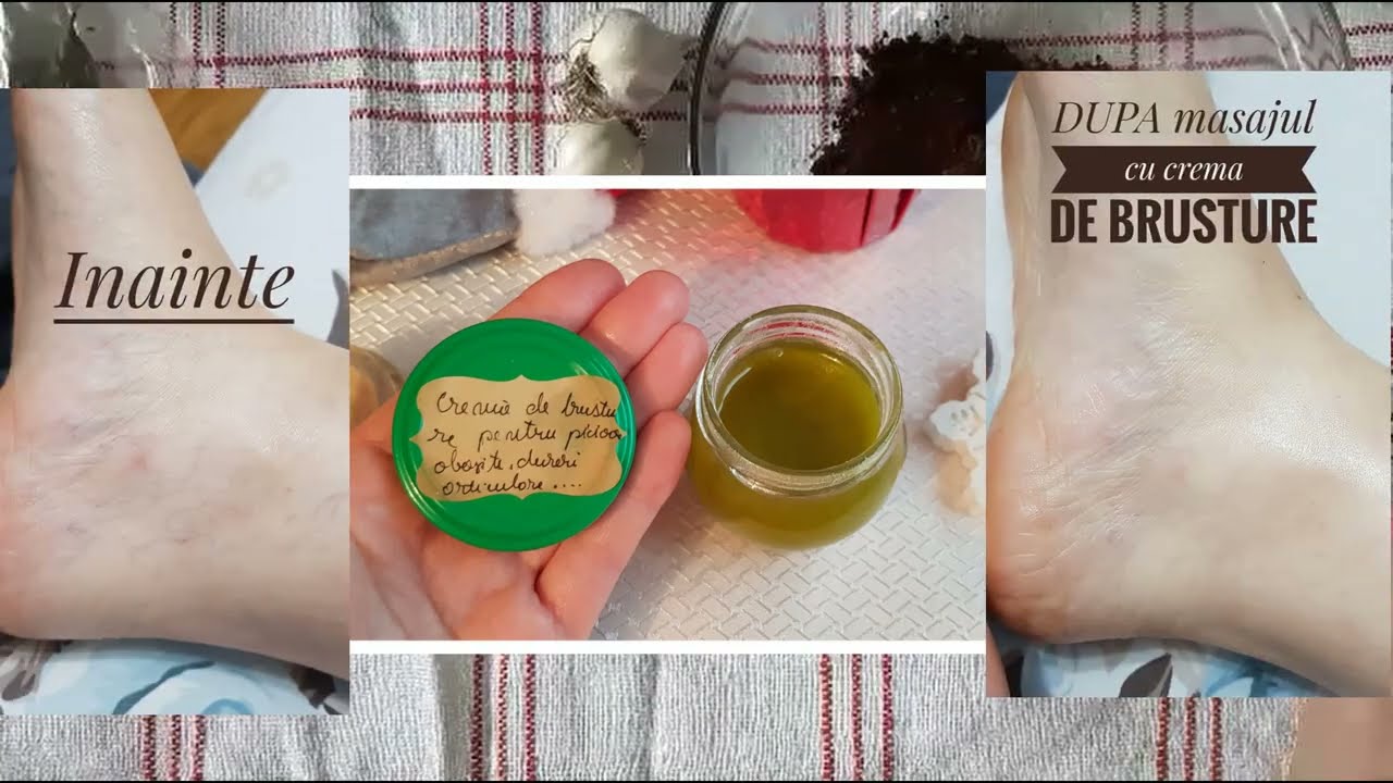 Trei tratamente naturiste pentru VARICE - trebuie sa le incerci - YouTube