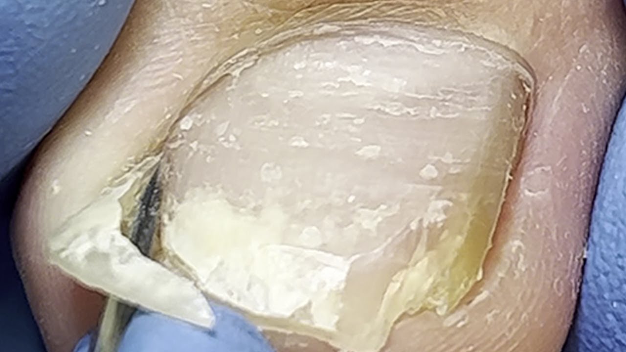 Mottled nail fungus! Complete pruning process【Xue Yidao Pedicure】 - YouTube