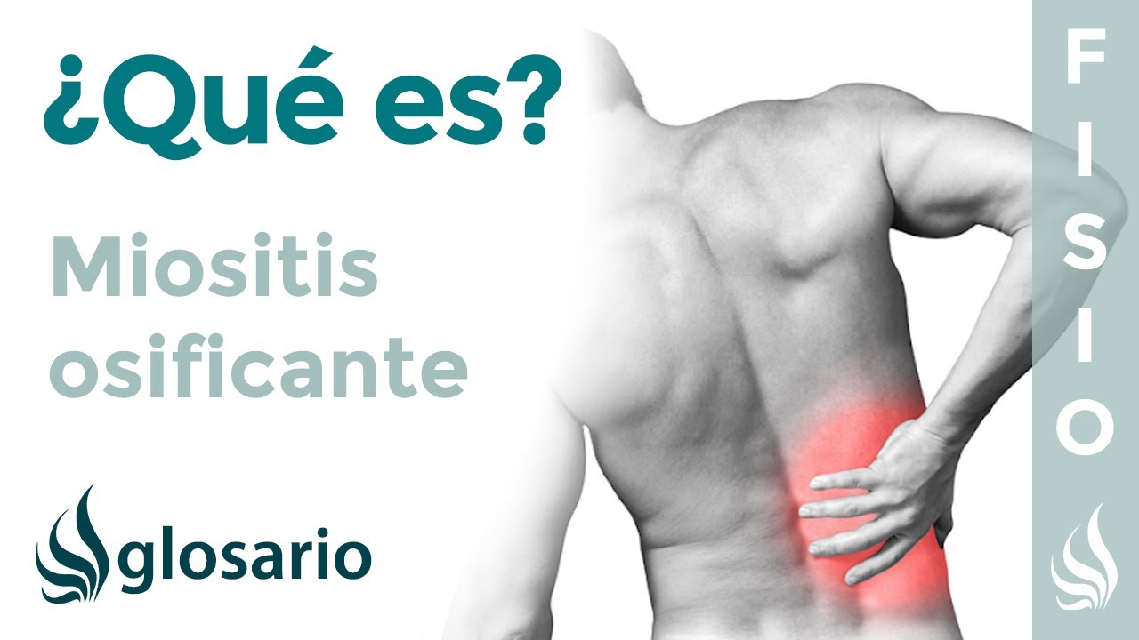 MIOSITIS OSIFICANTE | Qué es, qué afecta, síntomas, causas y ...