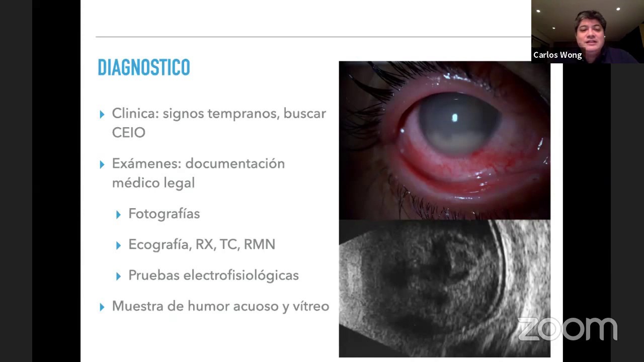 Endoftalmitis - YouTube