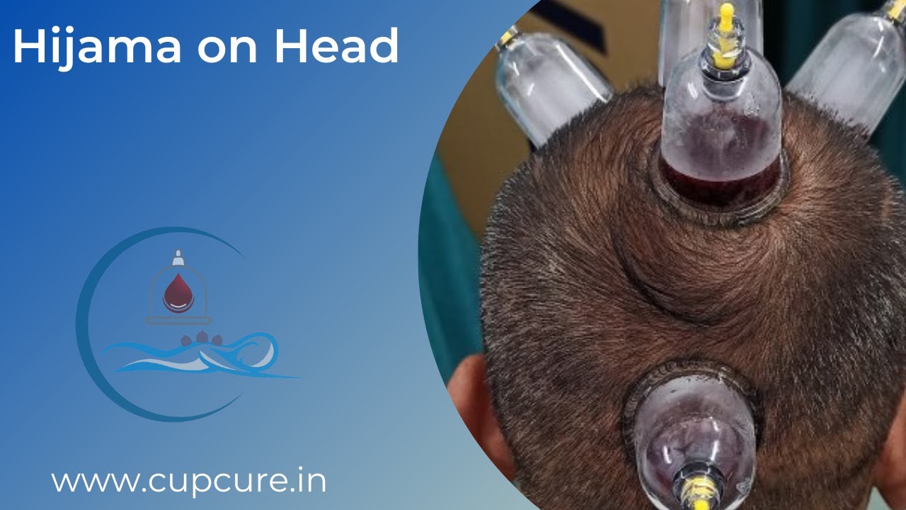 Doing Hijama on Head | CupCure Hijama Training - YouTube