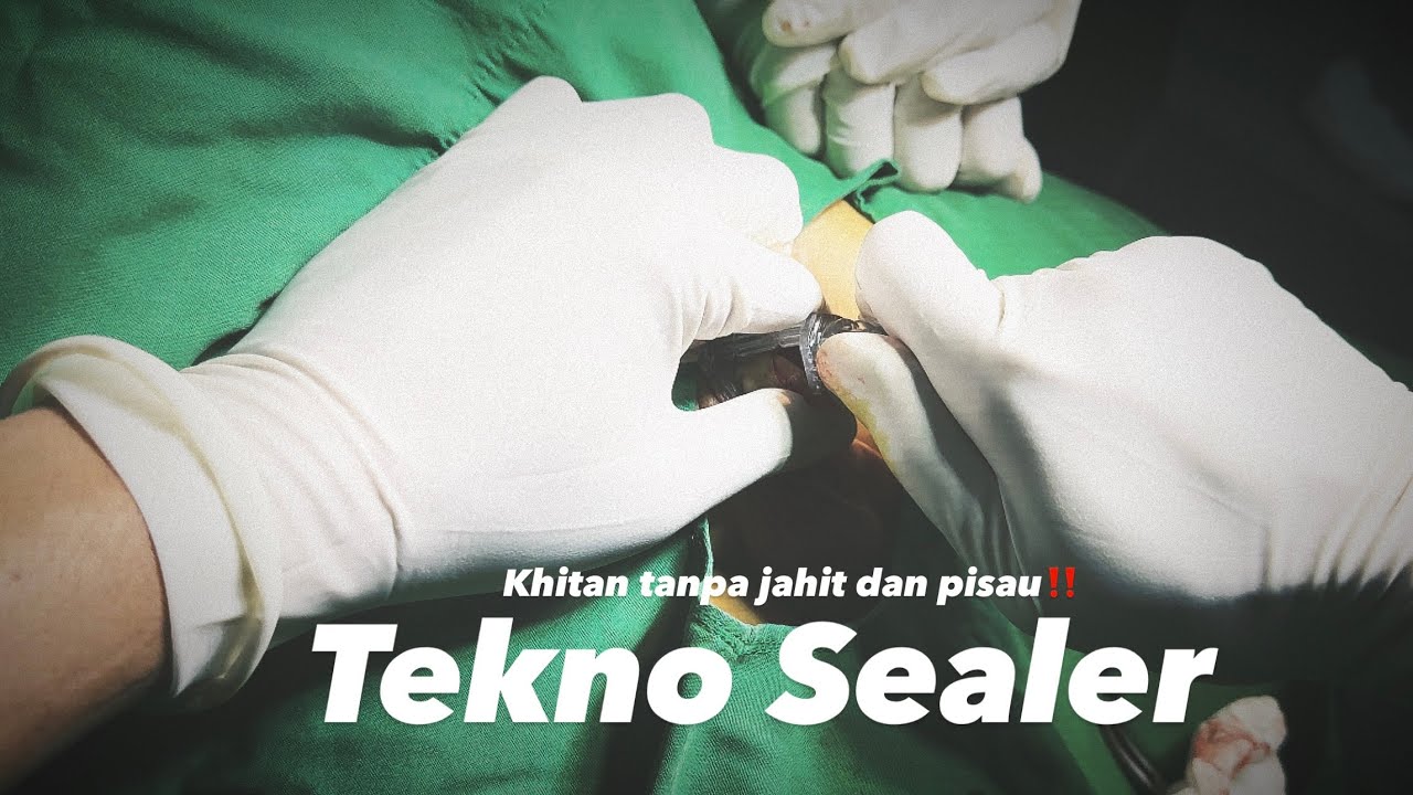 Sunat Tanpa Pisau dan Tanpa Jahit, Tekno Sealer - YouTube