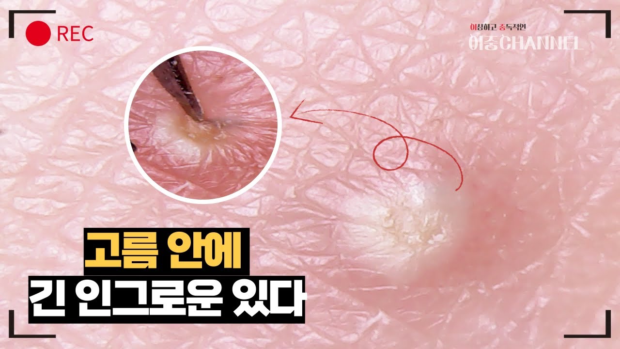고름 안에 긴 인그로운 있다 ingrown hair in pus - YouTube