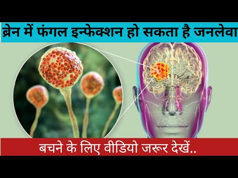 Brain Fungal Infection | Mucourmycosis | ब्रेन में फंगल इन्फेक्शन - YouTube