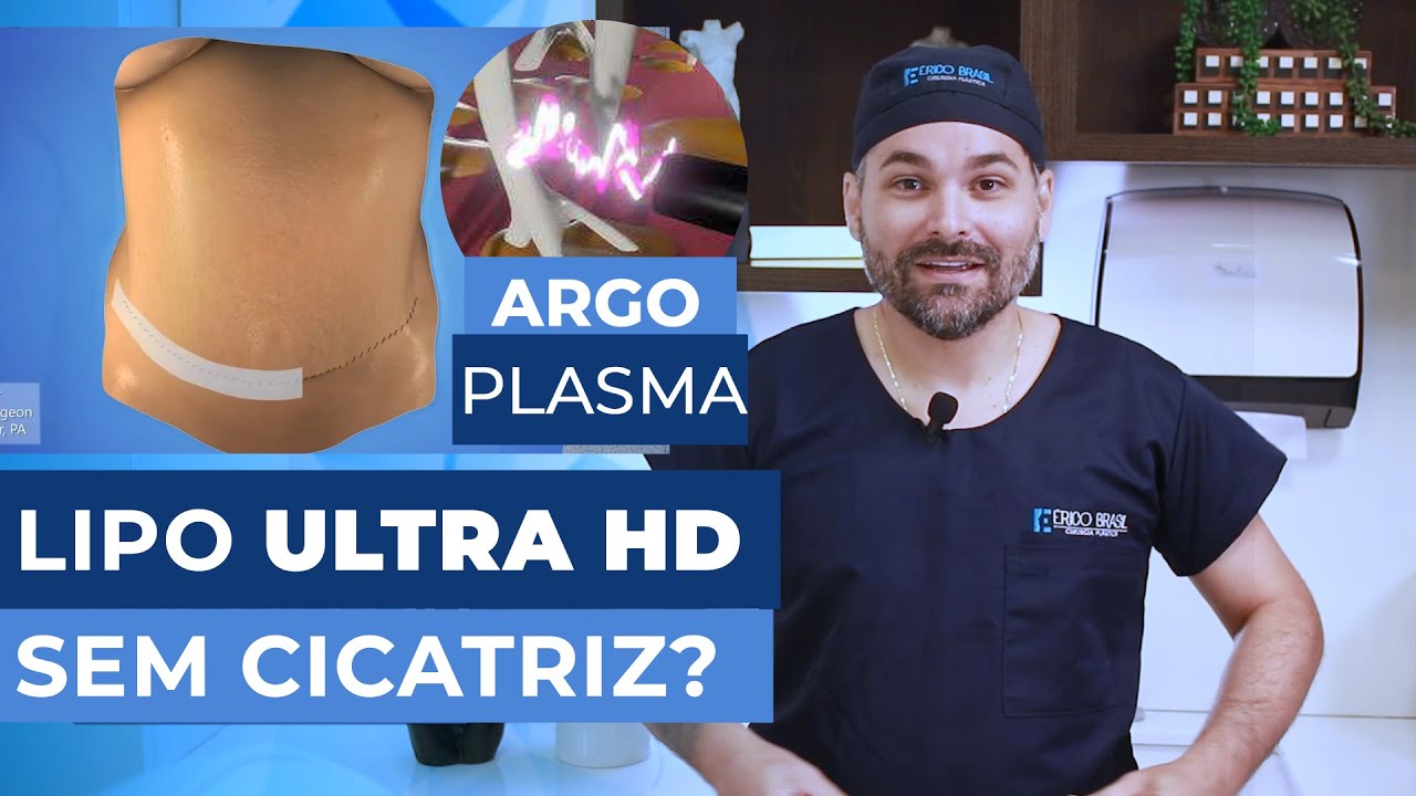 LIPO HD e Lipo Ultra HD com ArgoPlasma - YouTube