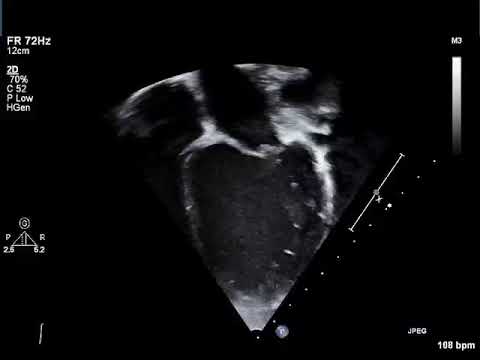 Ecocardiografía Transtorácica Carditis Reumática Aguda - YouTube
