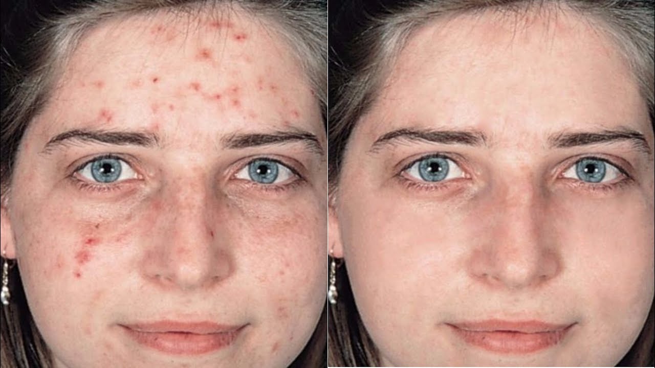 How To Remove Spot And Acne From Face In Photoshop CC YouTube how-to-remove-spot-and-acne-from-face-in-photoshop-cc-youtube