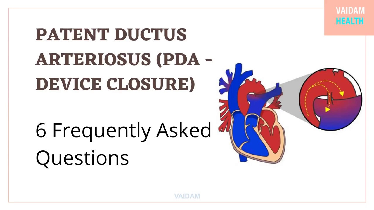 Patent Ductus Arteriosus 6 Frequently Asked Questions Youtube