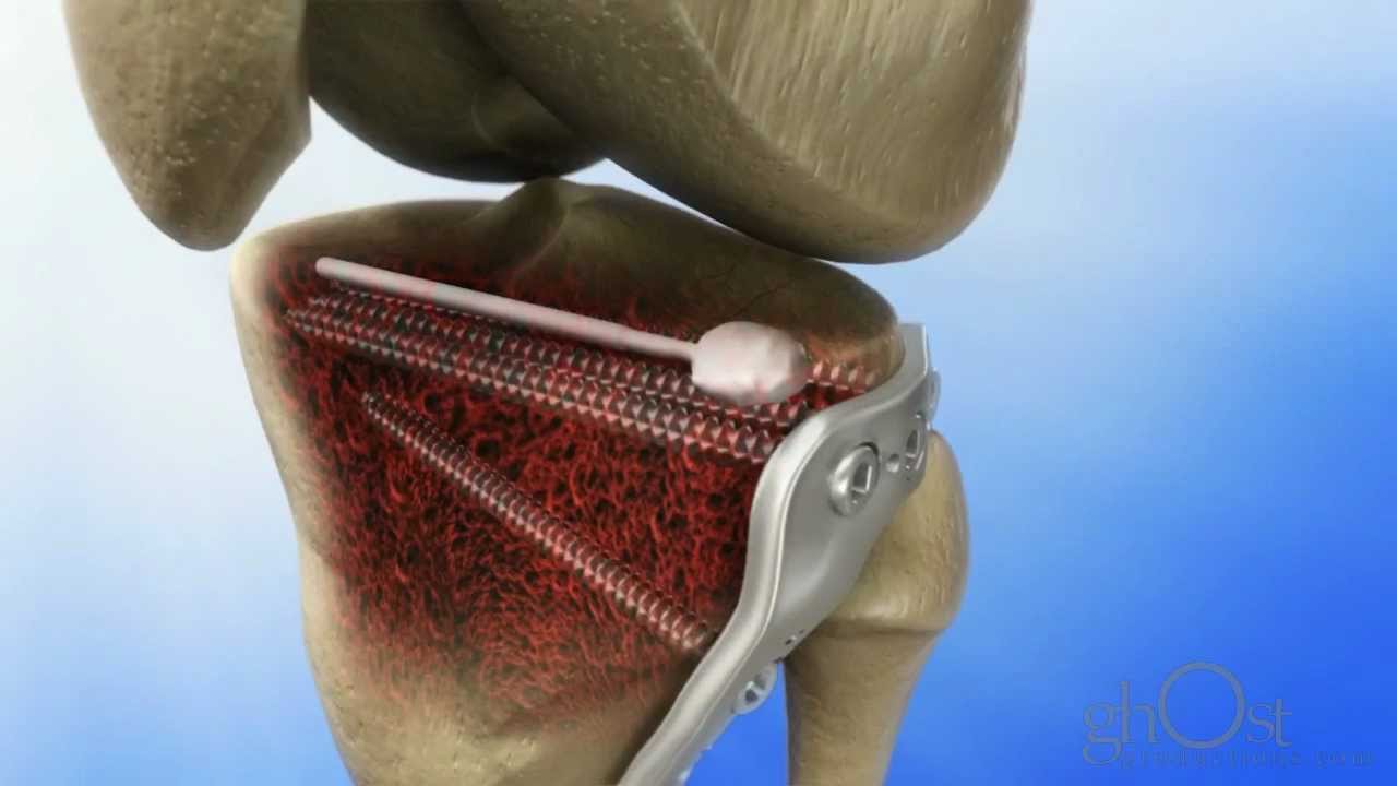 Ghost Productions - Medtronic - Tibial Plateau Inflatable Bone Tamp ...