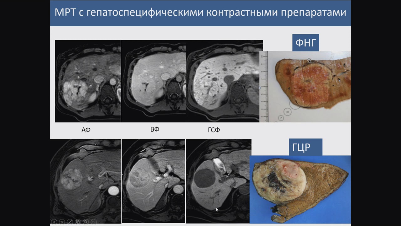 МСКТ МРТ в диагностике очаговых диффузных изменений печени