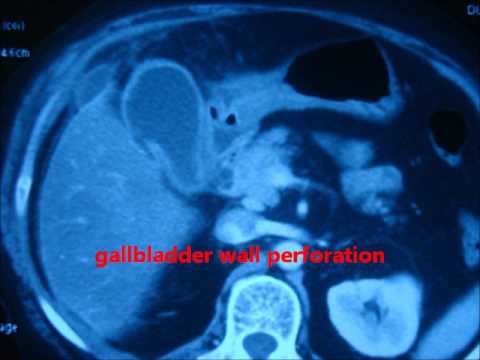 GALLBLADDER PERFORATION- CECT Findings. How to diagnose and manage ...