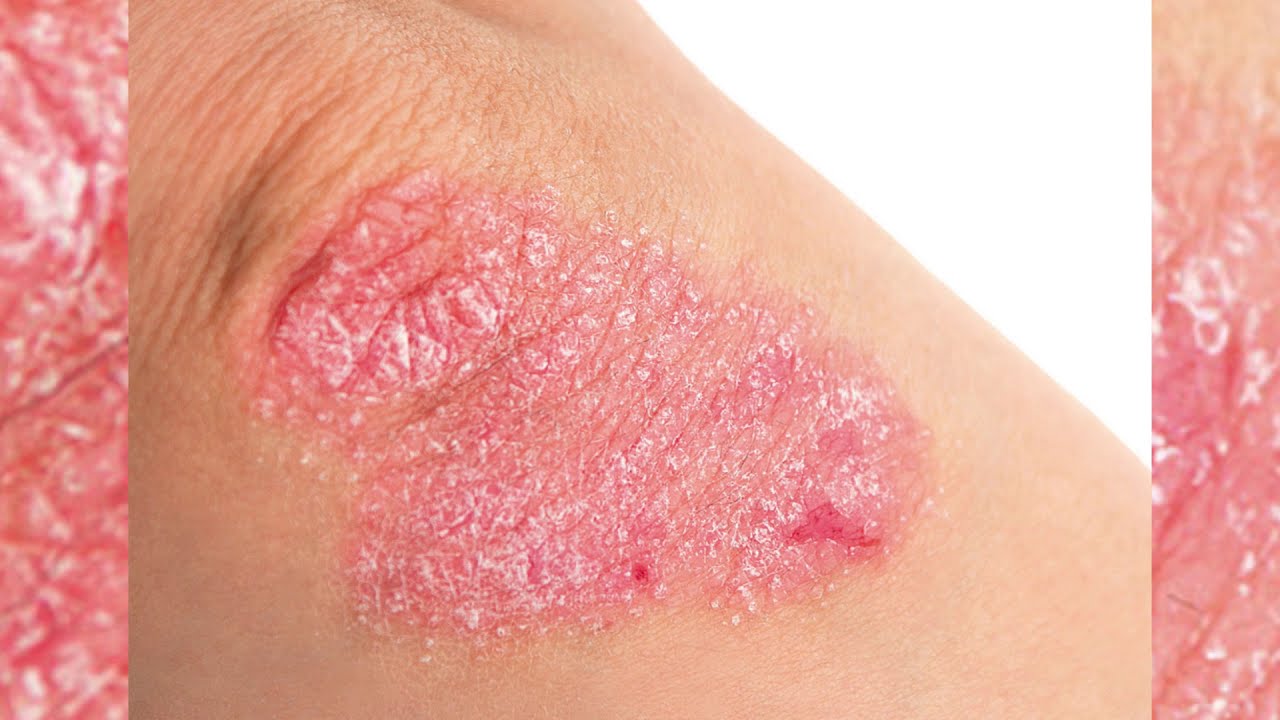 Mild Symptoms Of Plaque Psoriasis At Andrea Mcclelland Blog