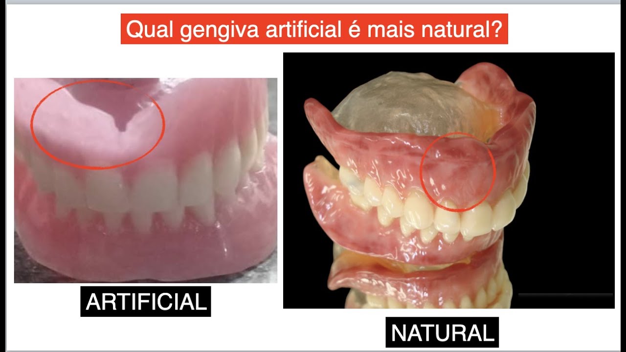 Prótese com gengiva artificial e a natural - YouTube