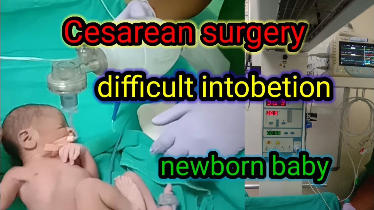 How is cesarean section ( LSCS) done # newborn baby very cute# very ...