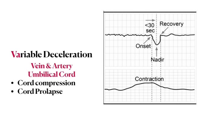 Variable Decelerations