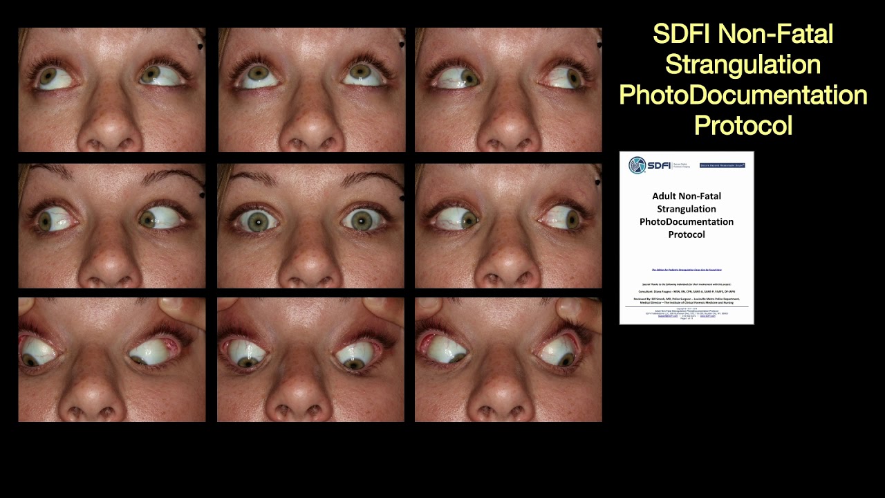 SDFI Pediatric Non-Fatal Strangulation Protocol Teaser - YouTube