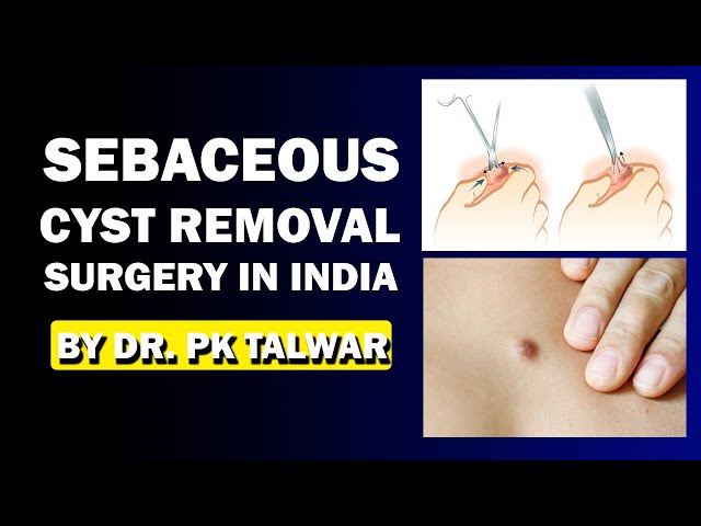 Epidermal Inclusion Cyst And Epidermoid Cyst What Are 42 Off