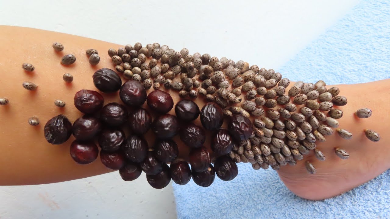 [ Amazing Ticks ] How to remove many ticks style on leg chubby boy ...