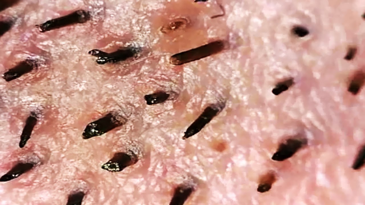 YouTube s Greatest Blackhead Popping Medical Videos We Want You youtube-s-greatest-blackhead-popping-medical-videos-we-want-you
