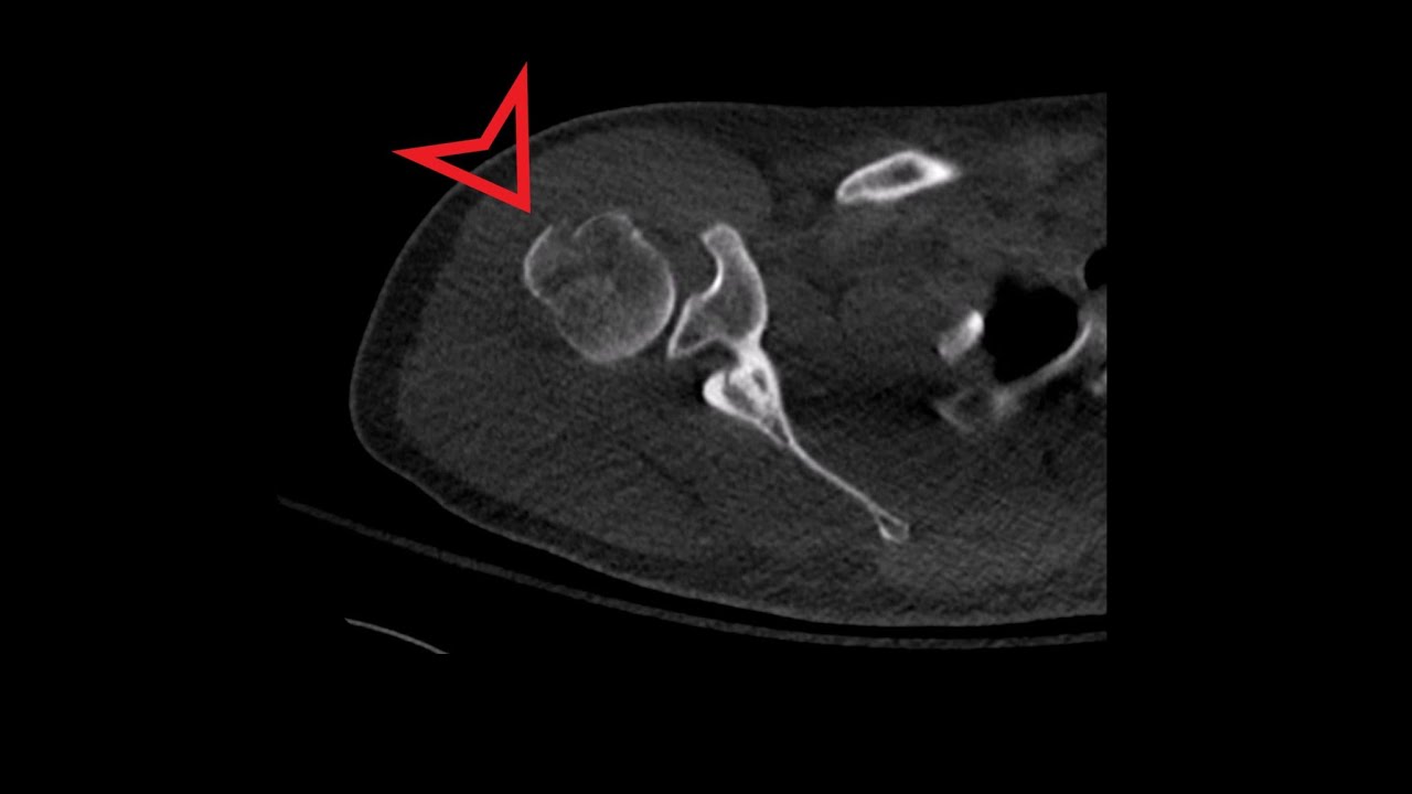 Shoulder CT: Humeral Head and Neck Fracture - YouTube