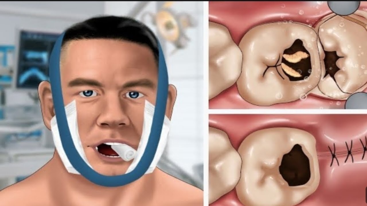 tooth animation and tooth extraction super satisfied video 👍👍👍👍 - YouTube