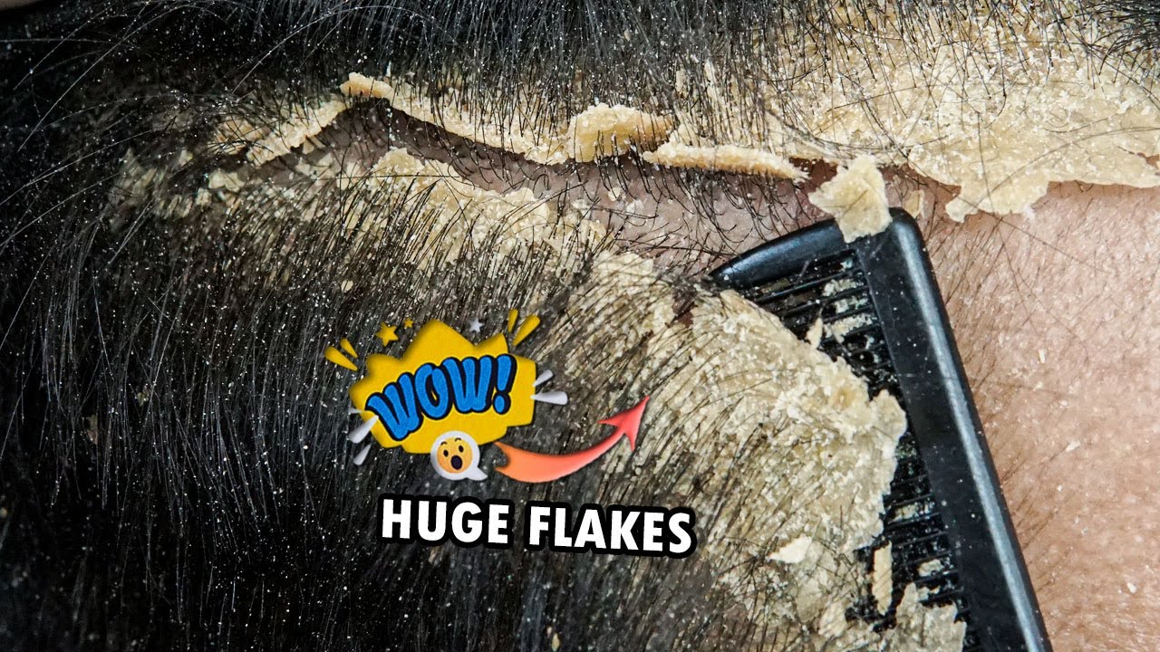 Huge Dandruff Flakes Scratching Around Ear #696 - YouTube